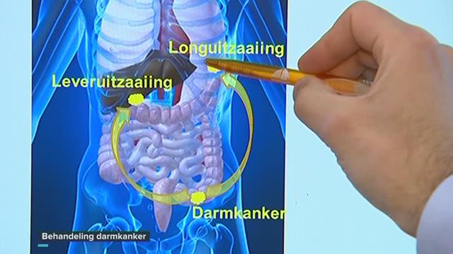 Wereldprimeur voor Kortrijks ziekenhuis in strijd tegen darmkanker